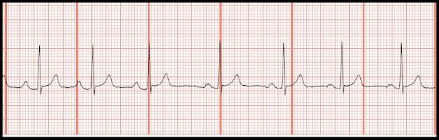 Practice ECG Rhythm Strips 102