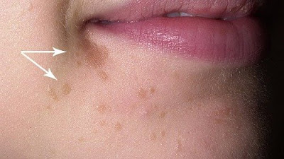 How to Remove the Small Warts Using a Single Ingredient - precious health