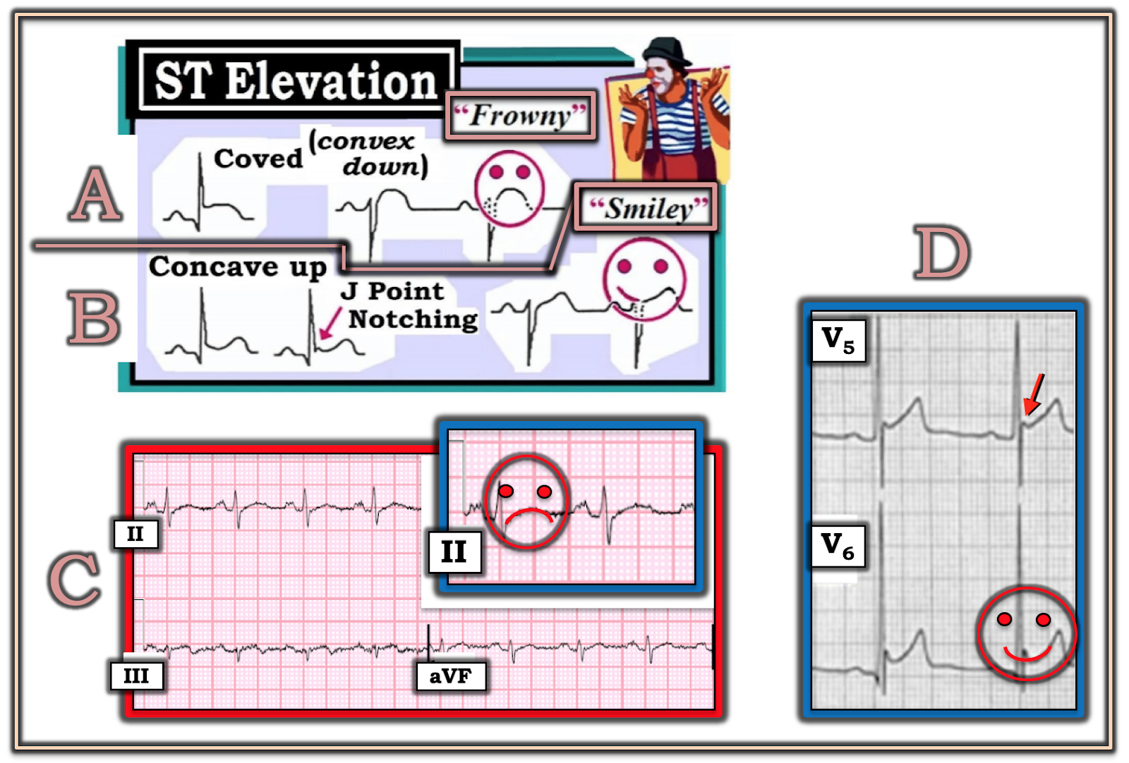 Dr. Smith's ECG Blog: ST segment concavity is just one small piece of ...