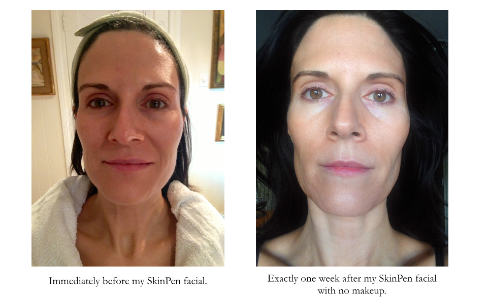SkinPen Review: Dynamic Results With Little Downtime | Gina Miller's ...