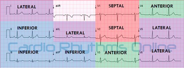 Curso de Lectura Electrocardiografica Veloz: Infarto