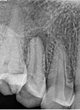 Proendodoncia.blogspot.com: puffs apicales: éxito o fracaso endodóntico