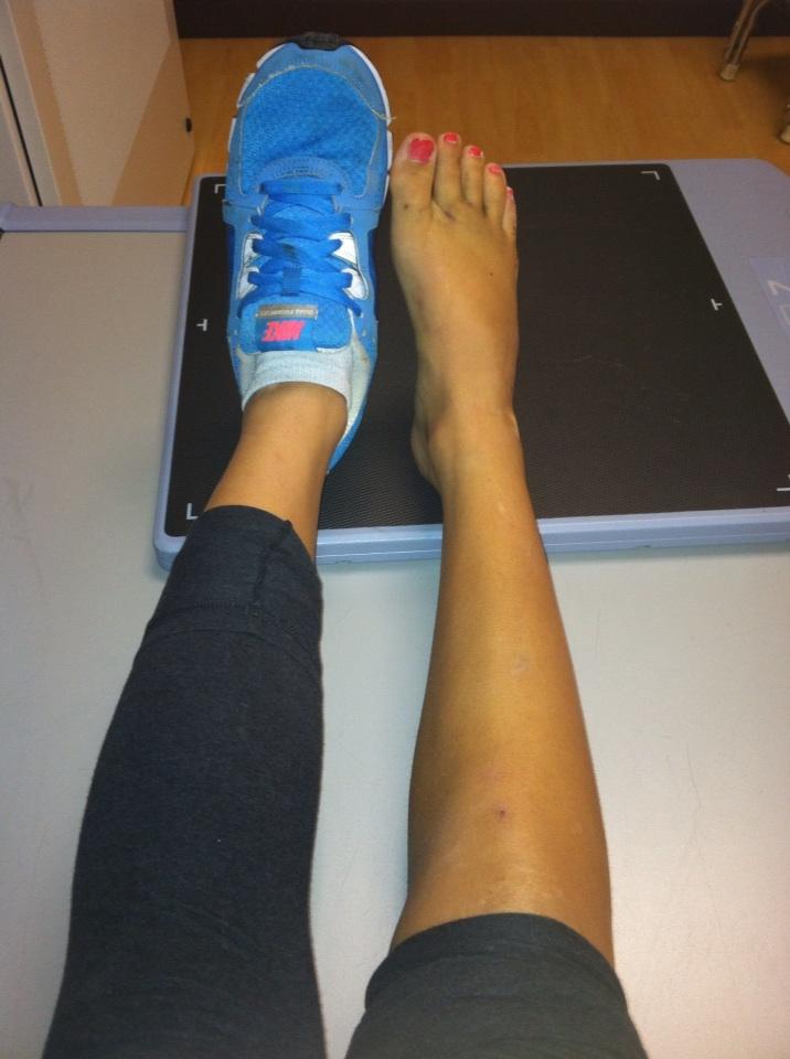 Casts and Toes: Random Assortment of Cast Pics