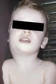 Abscesos Profundos de Cuello