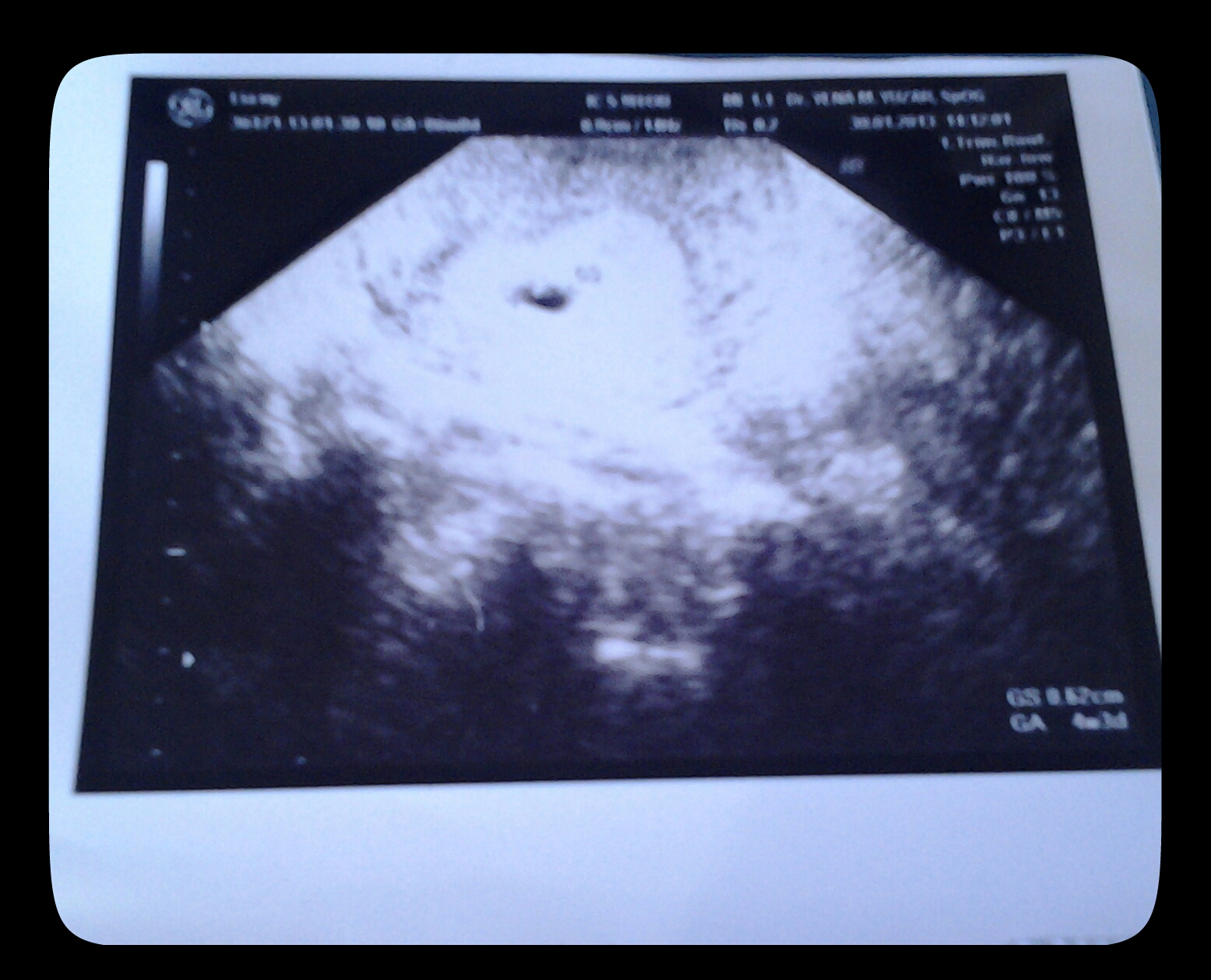 MommyLeje PapiYeyeb Dede s First Ultrasound Pictures mommyleje-papiyeyeb-dede-s-first-ultrasound-pictures