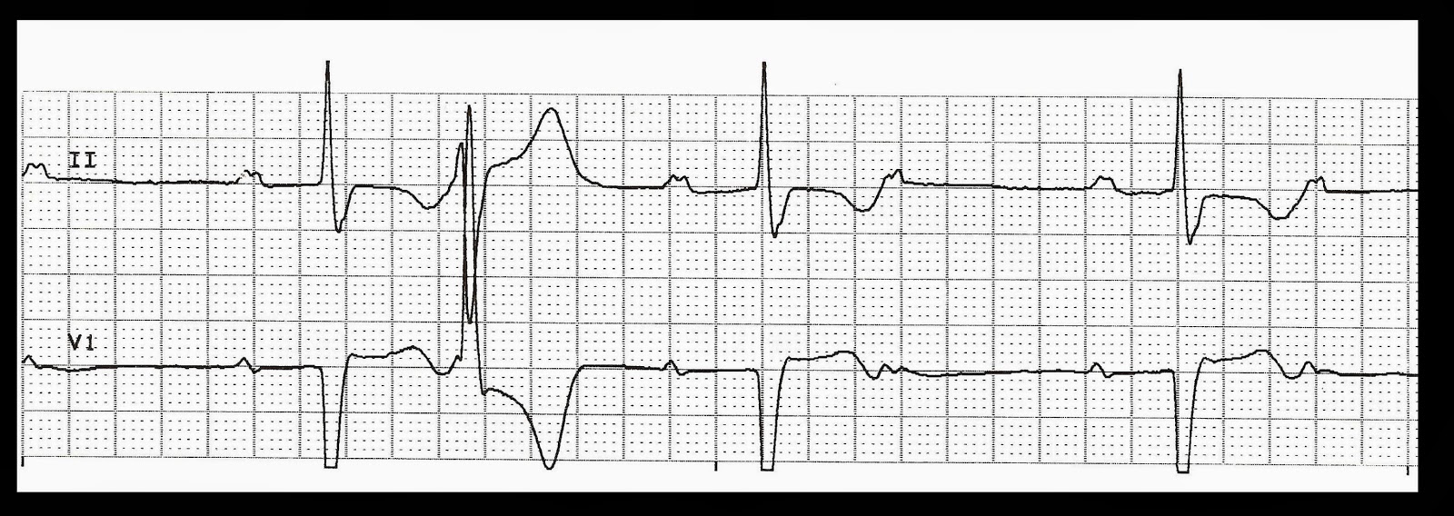 Various 2nd Degree Heart Block Type II