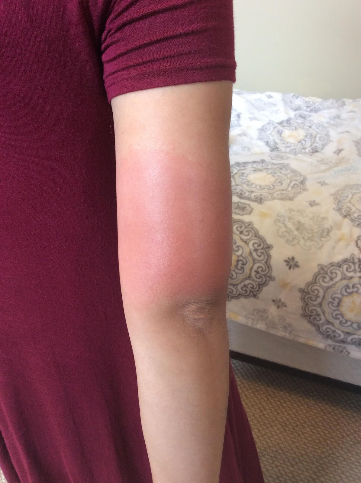 The doctor told me I have cellulitis 6-26-2017 - Hermana McKenna Swapp