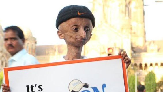 Entertainment sports news 15 year old Indian Boy Who Suffered From Rare Genetic Disorder That entertainment-sports-news-15-year-old-indian-boy-who-suffered-from-rare-genetic-disorder-that
