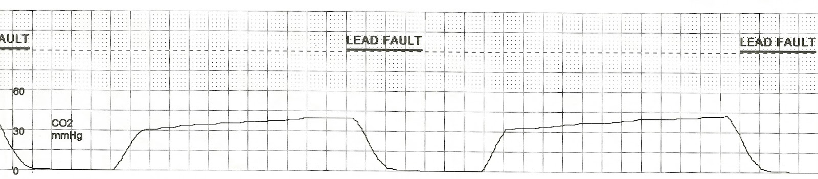 Continuous Waveform Capnography