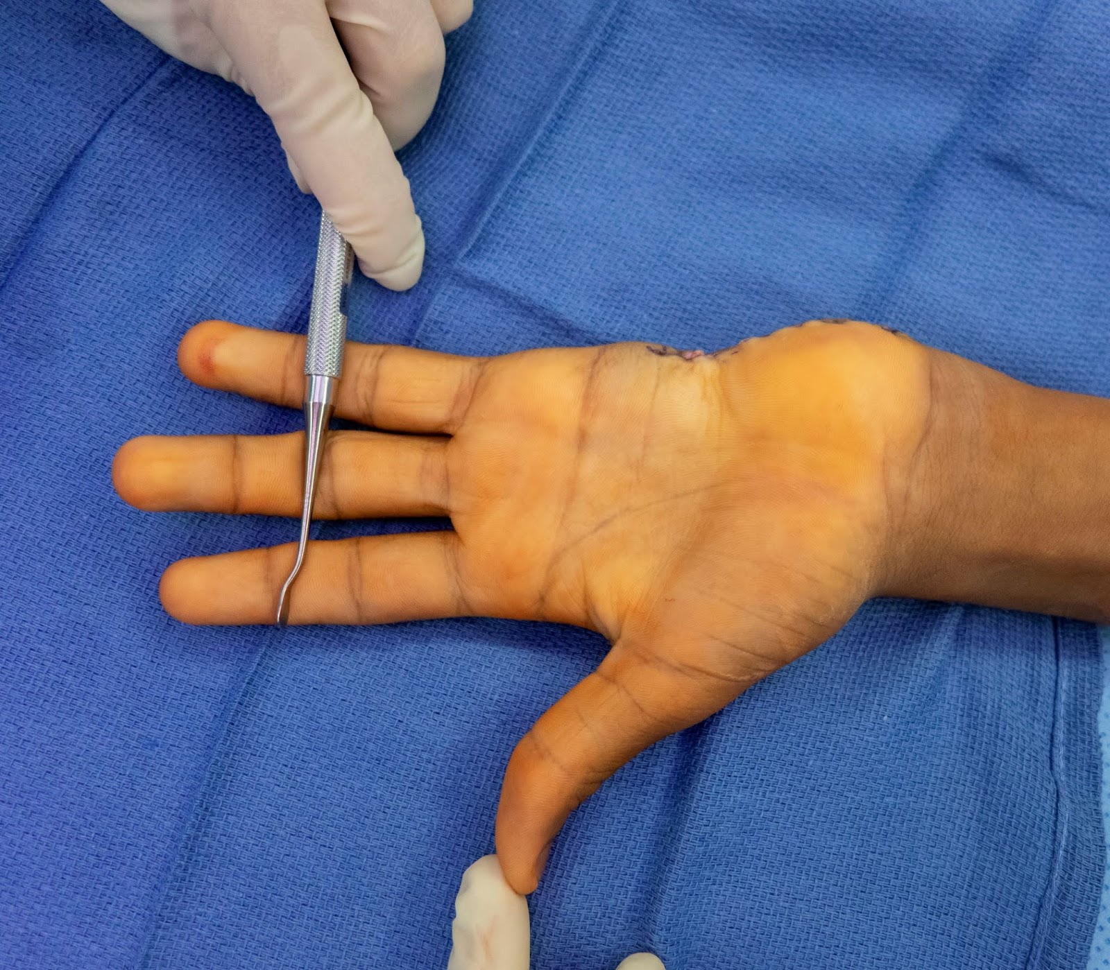 Not the typical hand deficiency- ulnar cleft hand | Congenital Hand and ...