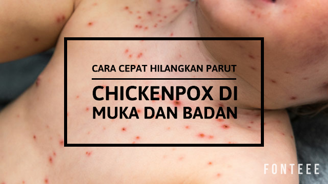 Chickenpox Cks