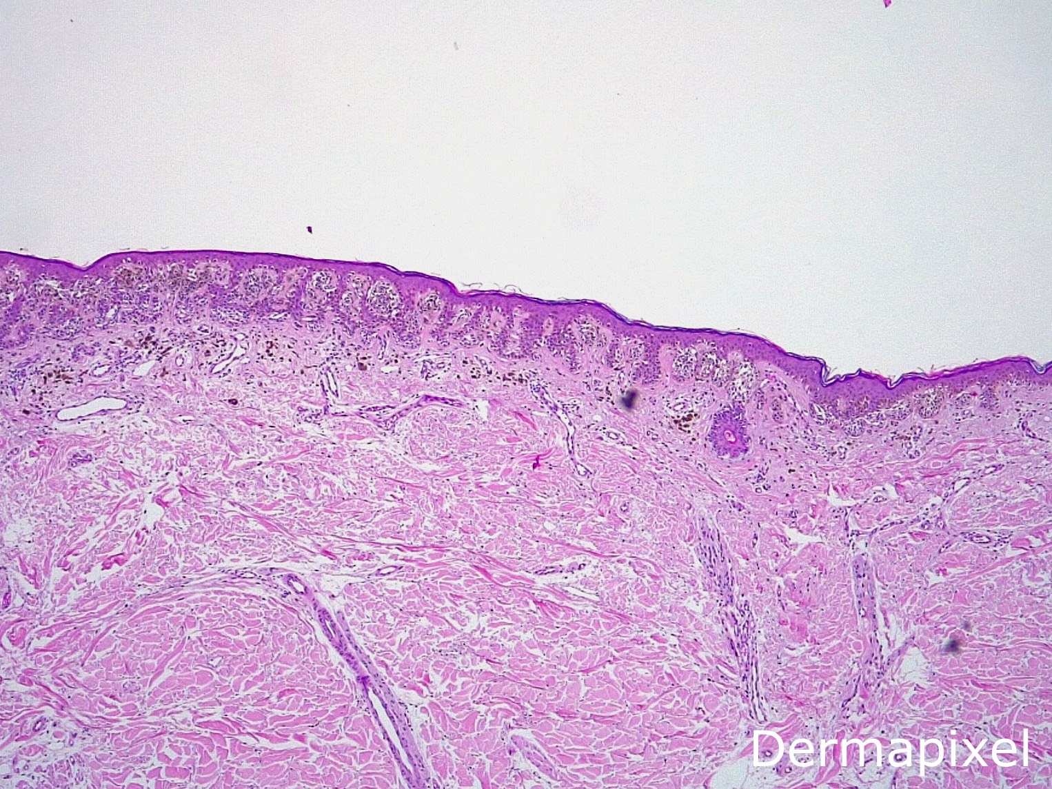 Dermapixel: Nevus displásico: ¿El bueno, el feo o el malo?