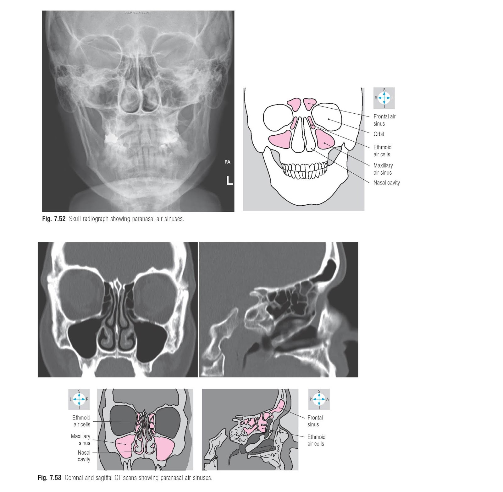 Nasal Cavities and Paranasal Air Sinuses Anatomy - pediagenosis