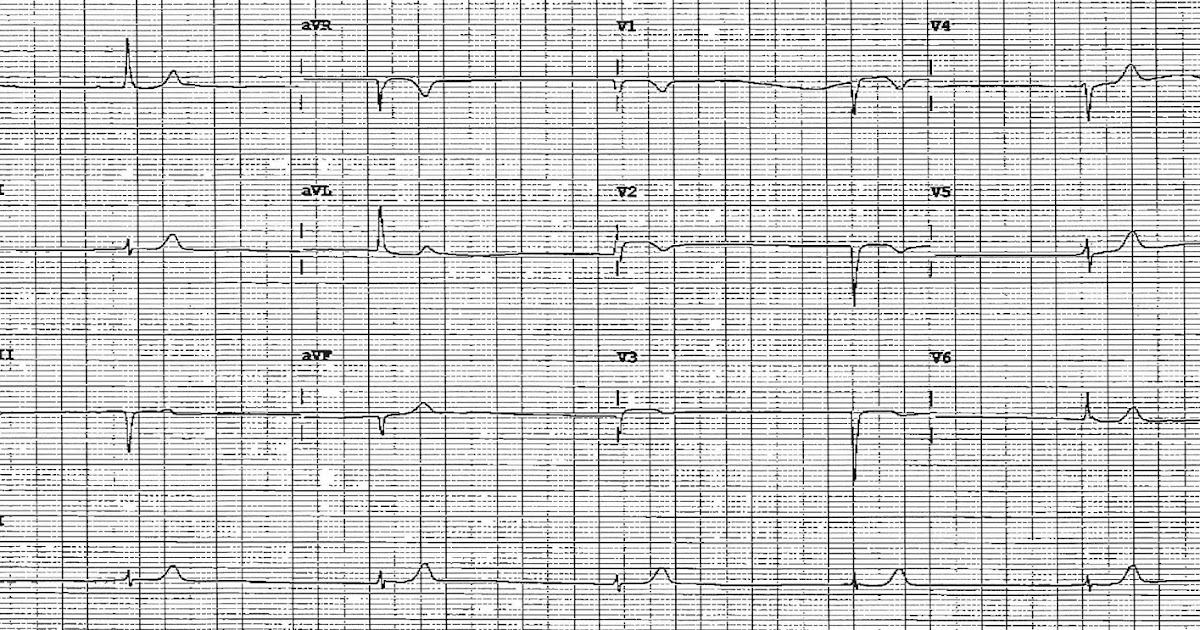 ECG of the Week: ECG of the Week - 13th February 2017 - Interpretation