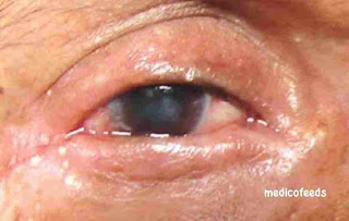 Disorders of Eyelids with pictures