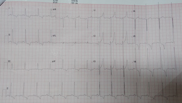 Cardiology window: Left ventricular hypertrophy with LV strain pattern
