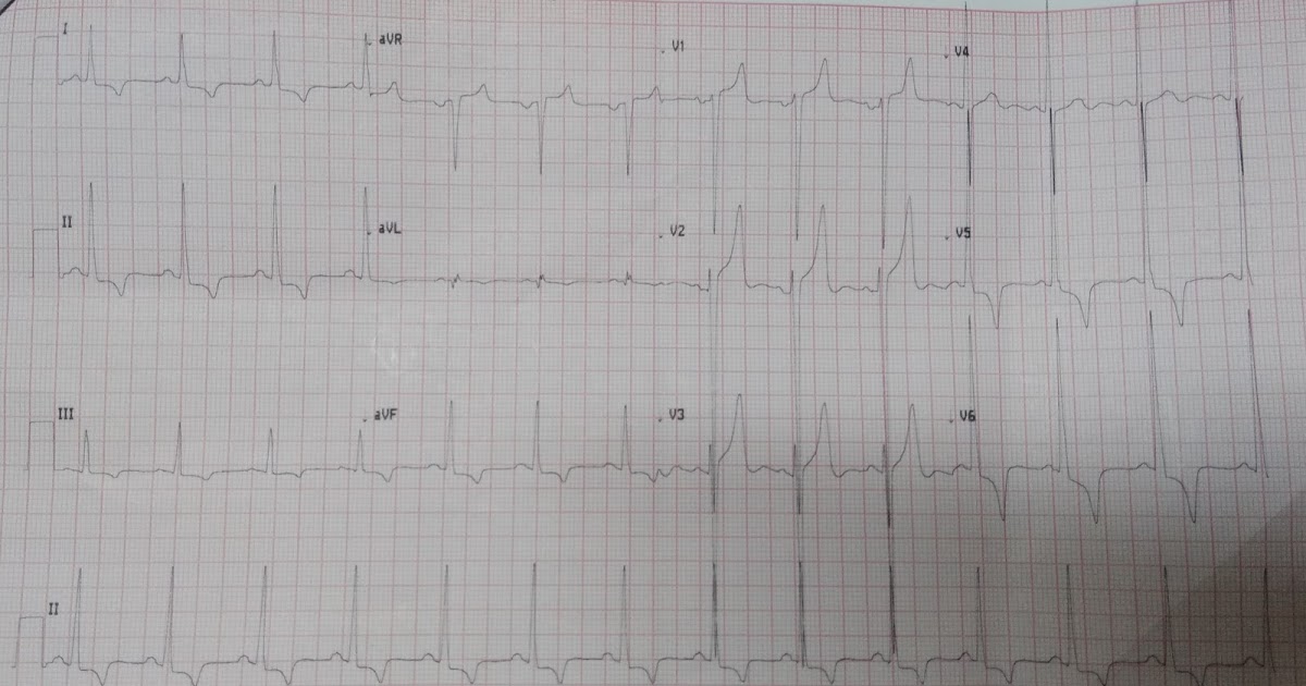 Cardiology window: Left ventricular hypertrophy with LV strain pattern