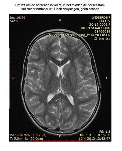 Femke en Moyamoya: MRI en MRI MRA beelden Femke