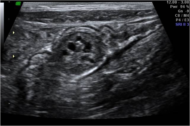 ‘DESCENDING COLONIC POLYP’- An ultrasound diagnosis - Sumer's Radiology ...