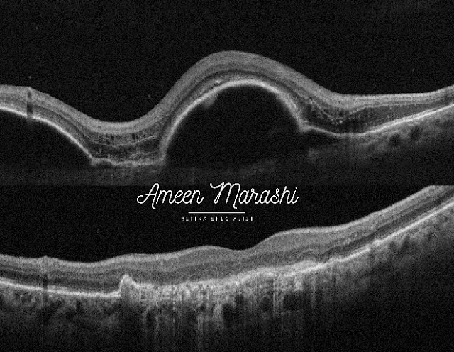 Serous PED Case report and Discussion