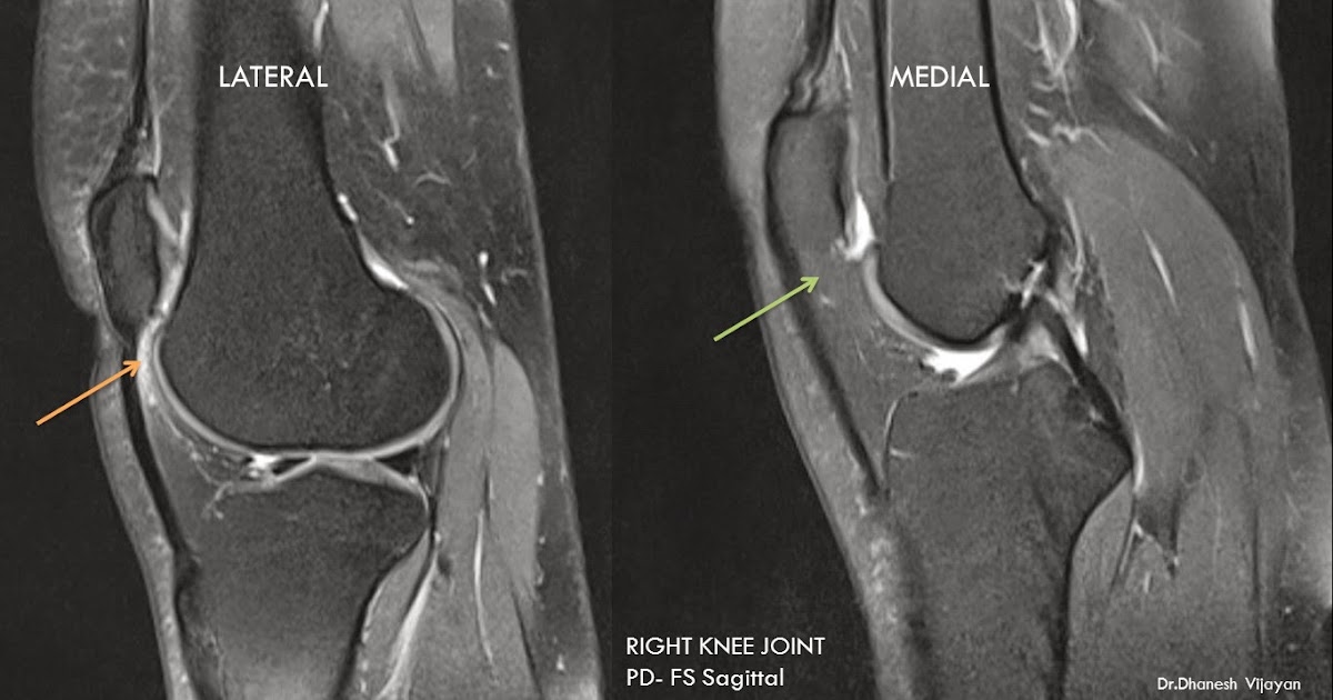 Ultimate Radiology : Hoffa's Fat Pad Impingement Syndrome