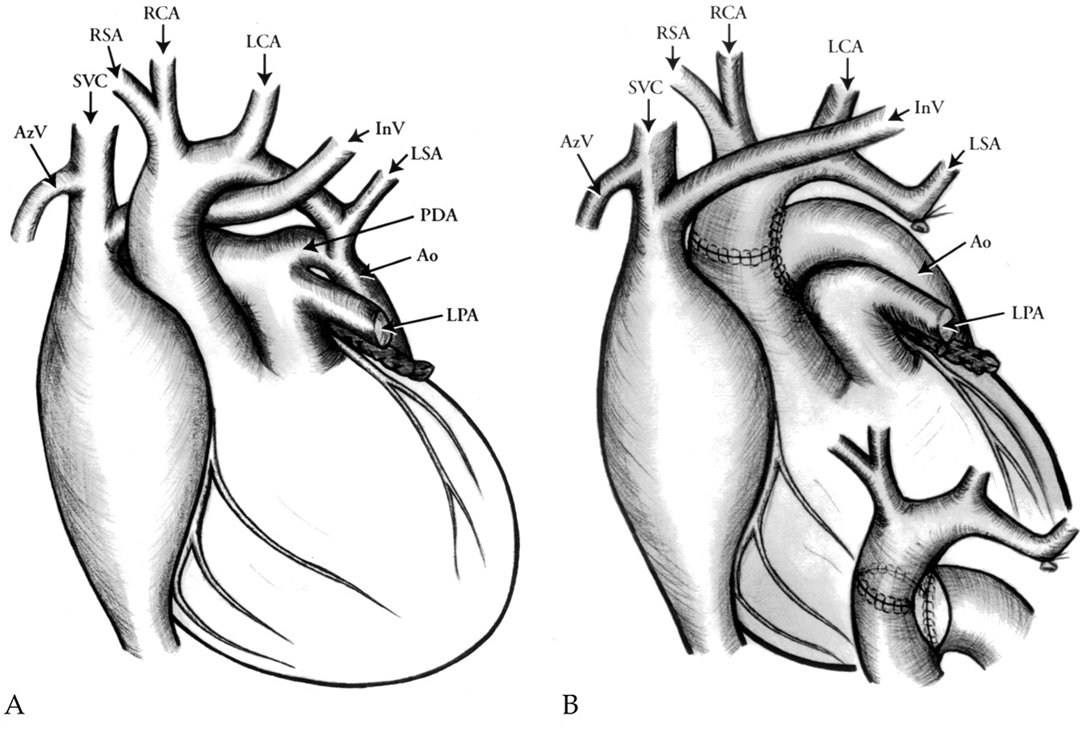 Pedi cardiology: Retroaortic Innominate Vein