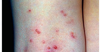 BACTERIAL INFECTIONS OF THE SKIN