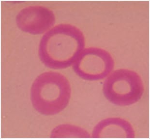 Fichero de Hematología: Anormalidades Eritrositarias.