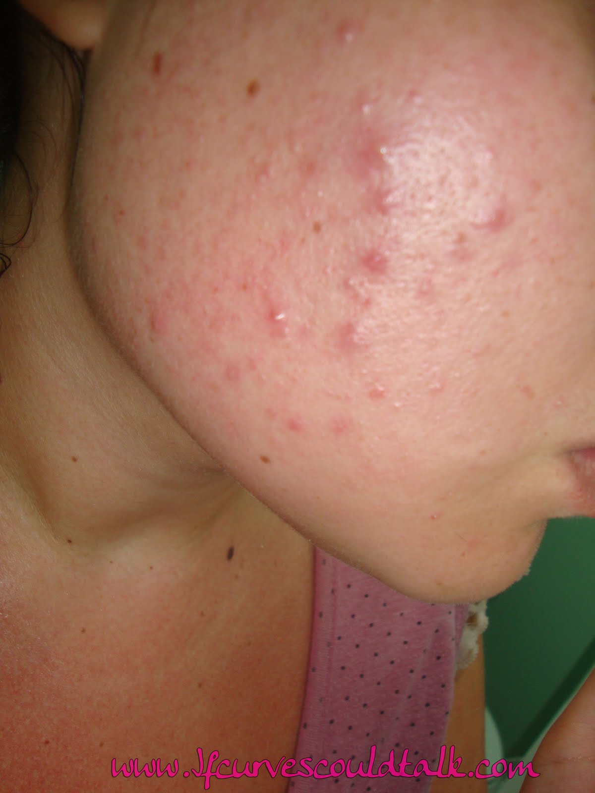 If Curves Could Talk: REVIEW: Clean & Clear Persa-Gel 10