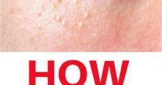 Shared Health News: How To Remove The Small White Skin Cysts