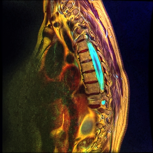 Nevit's blog: Dorsal Spine Color MRI