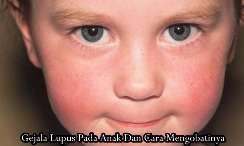 Gejala Lupus Pada Anak Dan Cara Mengobatinya