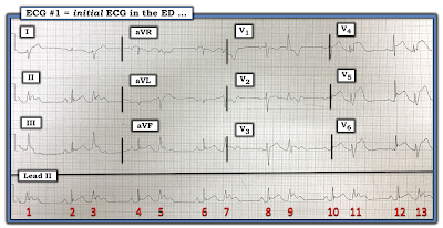 ECG Interpretation