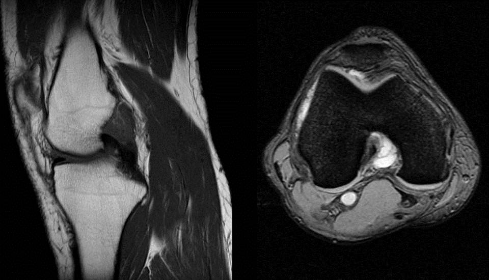 Radshare: GANGLION CYST OF KNEE
