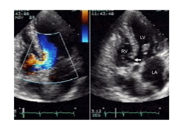 ECHOCARDIOGRAM /VSD