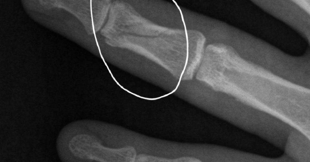 The Walker Family: Aaron Fractured His Finger 😲