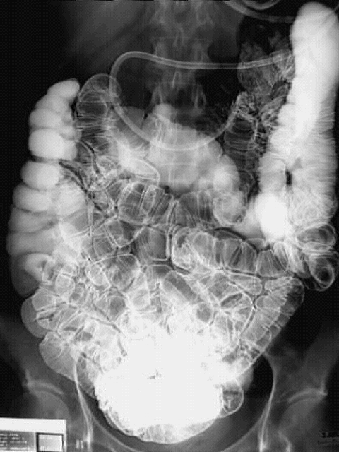 Hello USA: enteroclysis