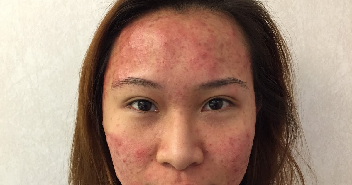 Dr Gerard Ee | Clifford: AGNES - The PERMANENT cure for adult acne ...