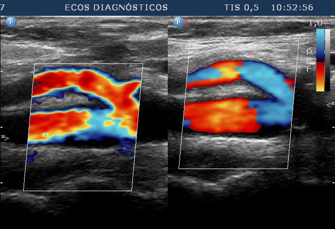 ECOGRAFIA: Doppler Vascular Colorido