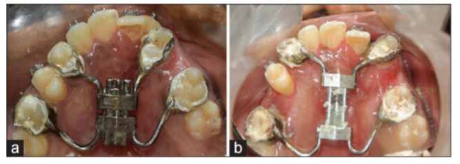 Anterior maxillary distraction osteogenesis