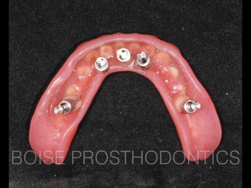Boise Idaho Prosthodontics: Immediate Load Implant Prosthesis - Hybrid