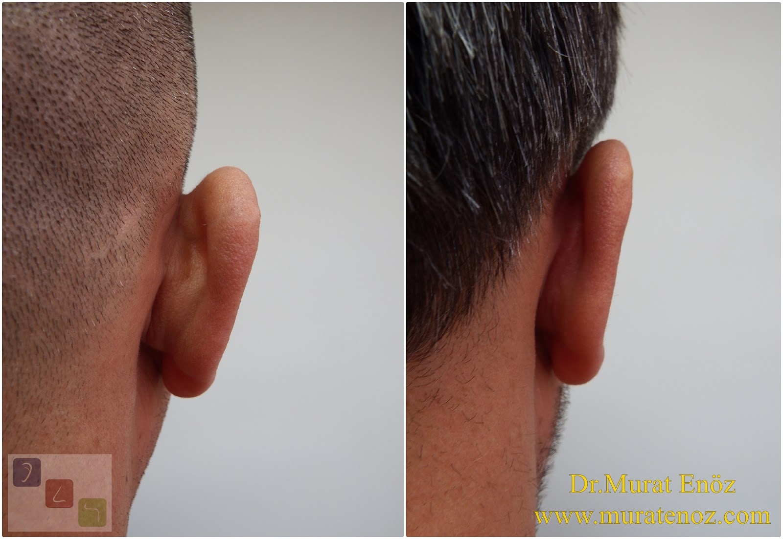 Advantages and Disadvantages of Modified Technique Prominent Ear ...