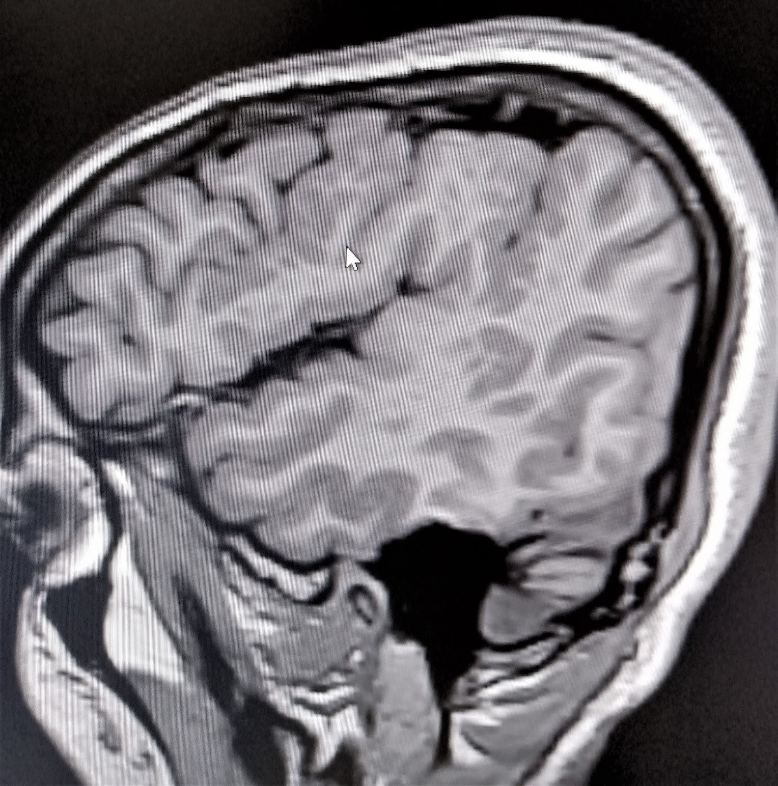 Polymicrogyria : MRI Teaching Case - Sumer's Radiology Blog