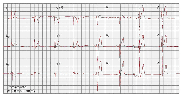 Curso de Lectura Electrocardiografica Veloz: Sindromes