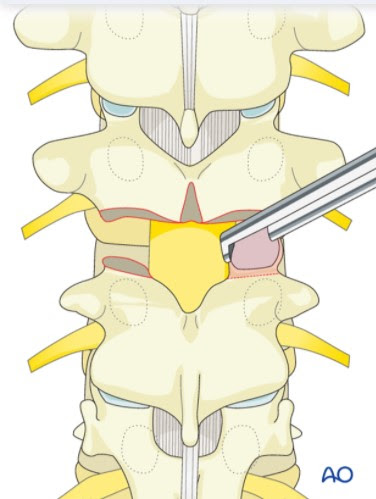Spine Osteotomies | Growing Spine Blog | Washington University in St. Louis