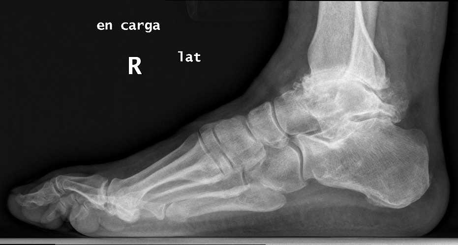 Fanáticos del pie: ATLAS DE PATOLOGÍA DEL PIE: ARTROSIS TOBILLO