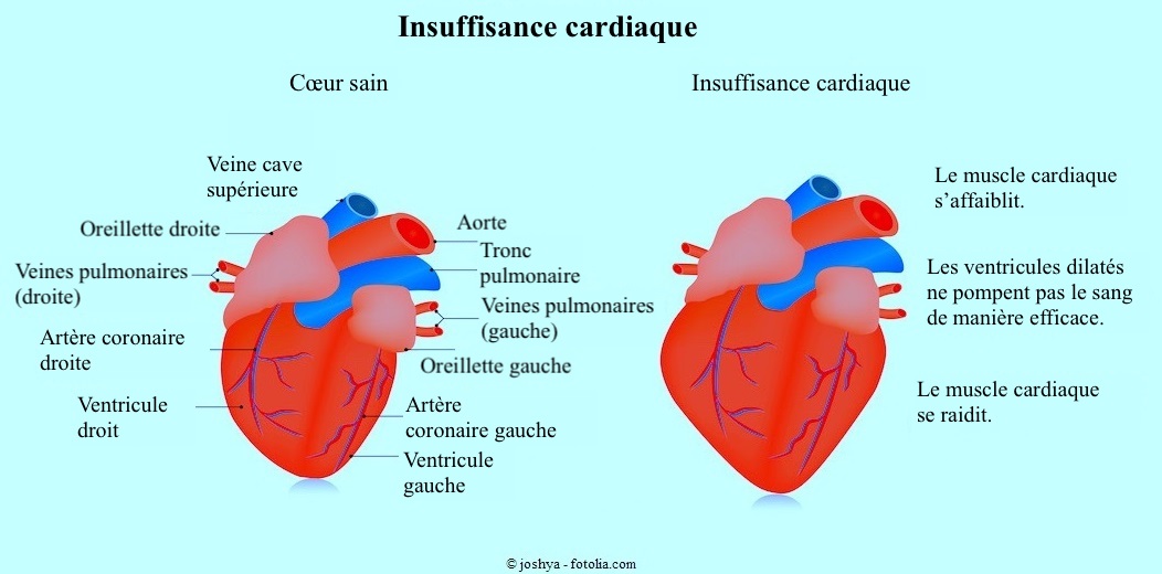 Tout savoir sur l'insuffisance cardiaque