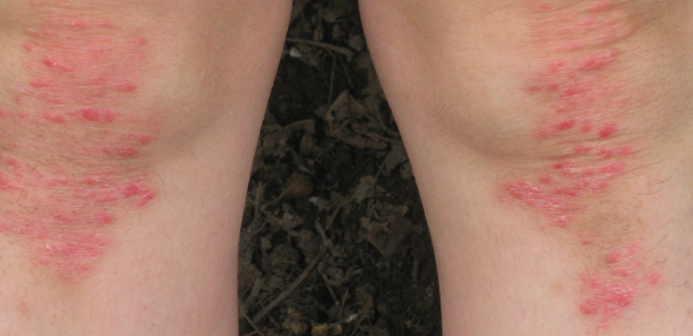Comment battre le psoriasis en 30 jours: Introduction - Jour 1