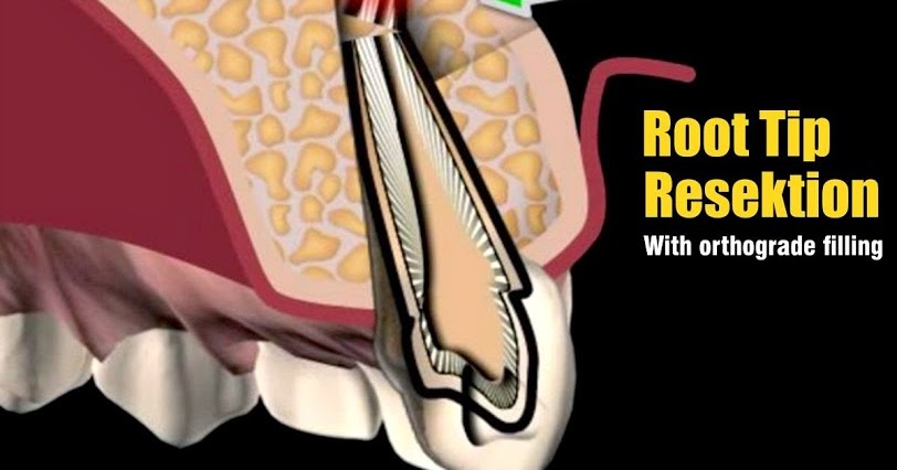ENDODONTIC: Root Tip Resektion with orthograde filling - Odonto-Tv