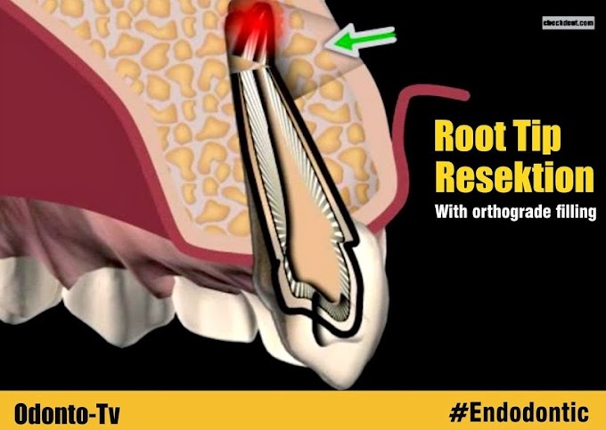 ENDODONTIC: Root Tip Resektion with orthograde filling